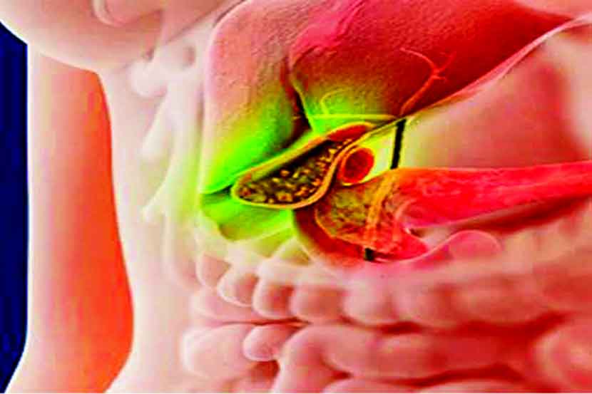पित्ताशयातील खडे - Marathi News | Gallstones Akp 94 - Latest ...