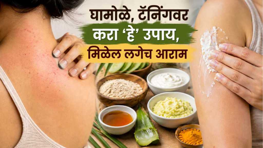 उन्हाळ्यात घामोळे, टॅनिंगमुळे हैराण झालात? आजच करा 'हे' उपाय; जळजळ, खाज ...